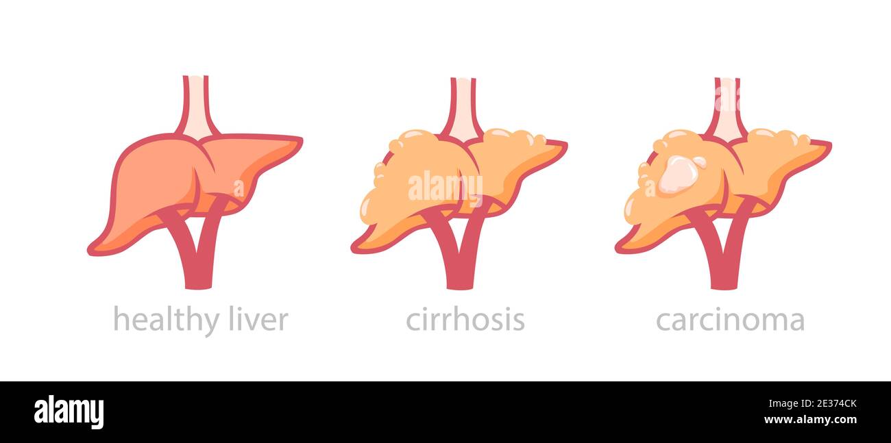 Healthy liver and tumor damaged illustration. Process transformation ...