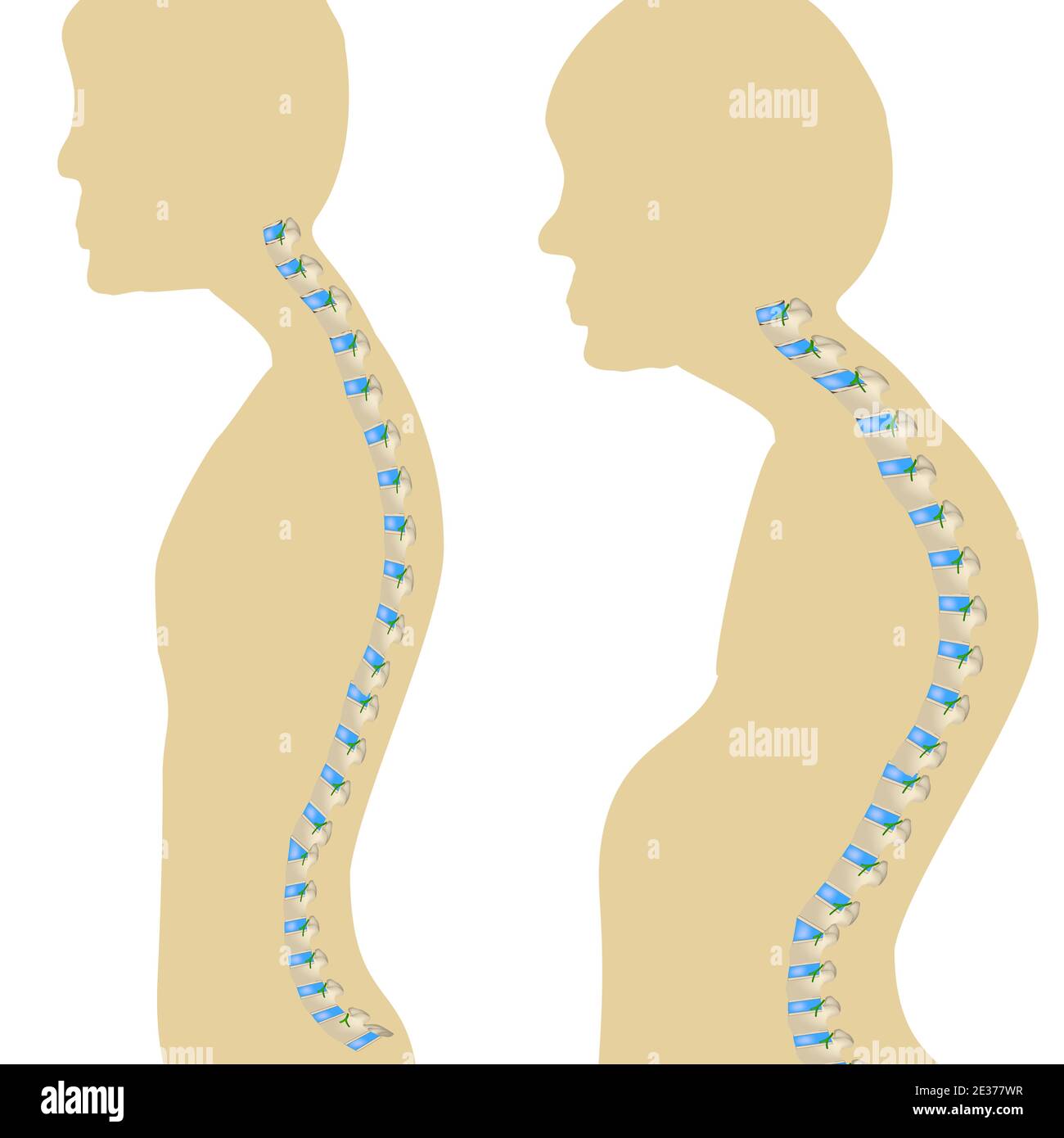Kyphotic Spine Posture