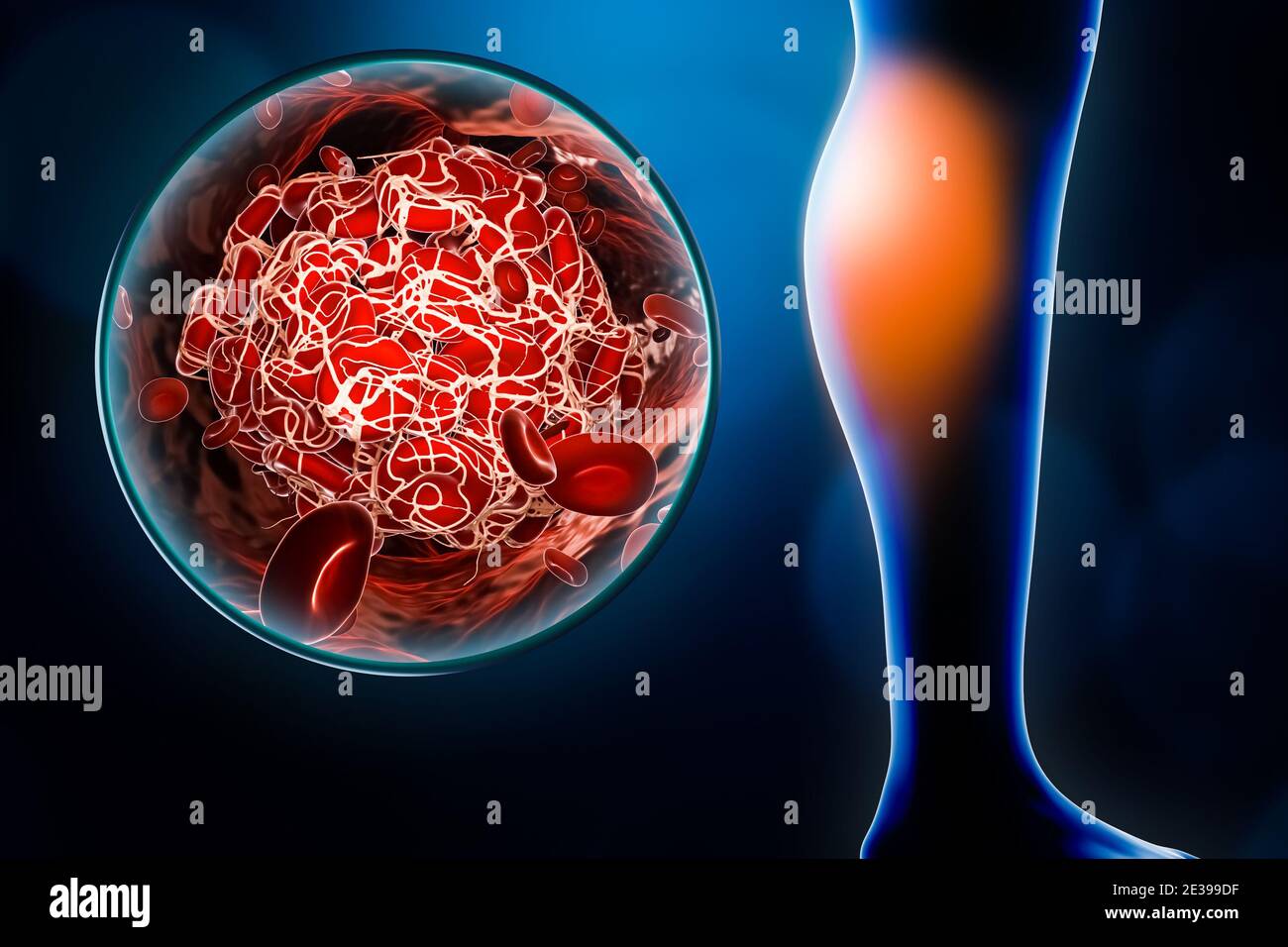Blood clot and leg hi-res stock photography and images - Alamy