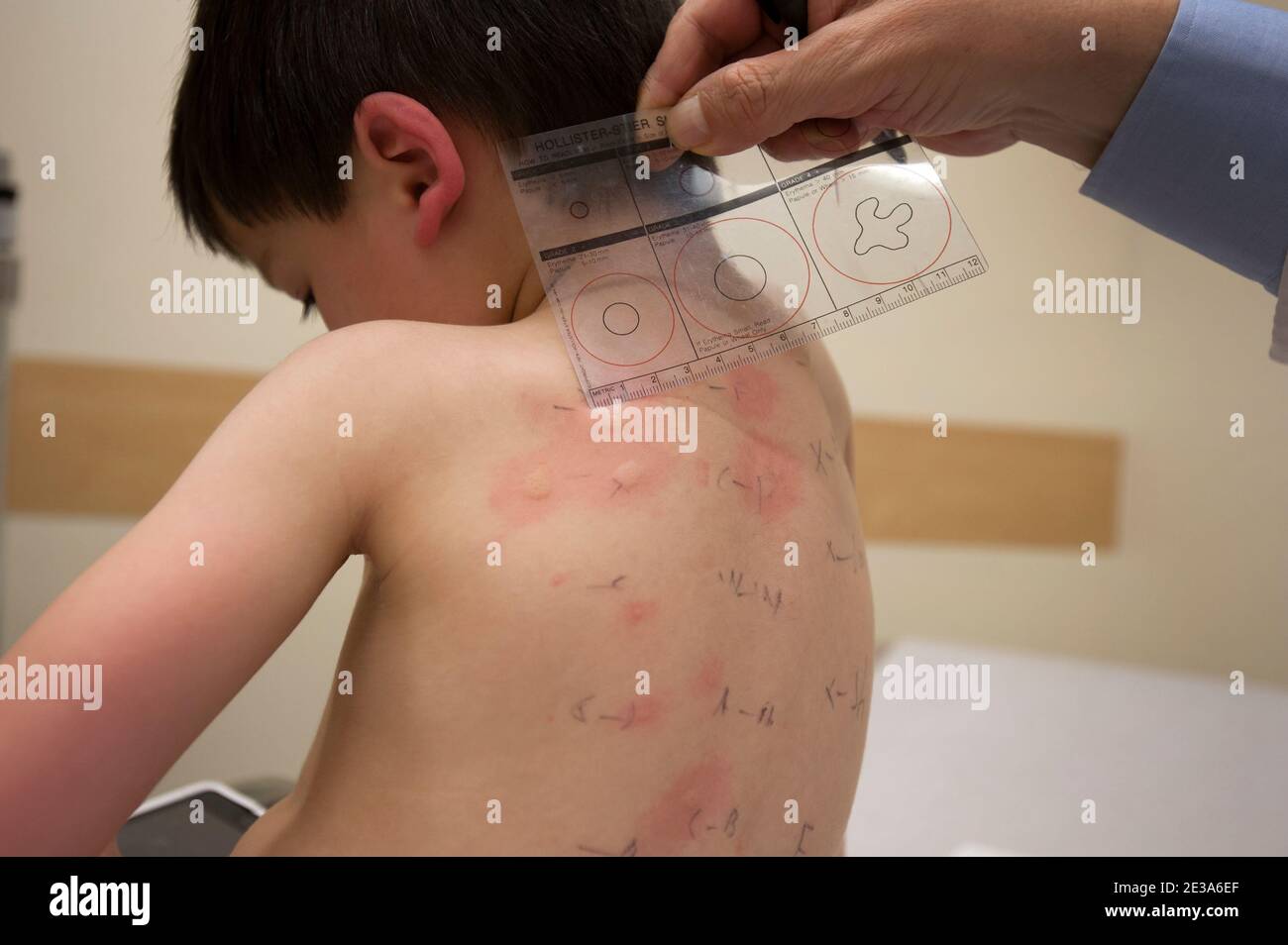 Toddler skin prick test Stock Photo - Alamy