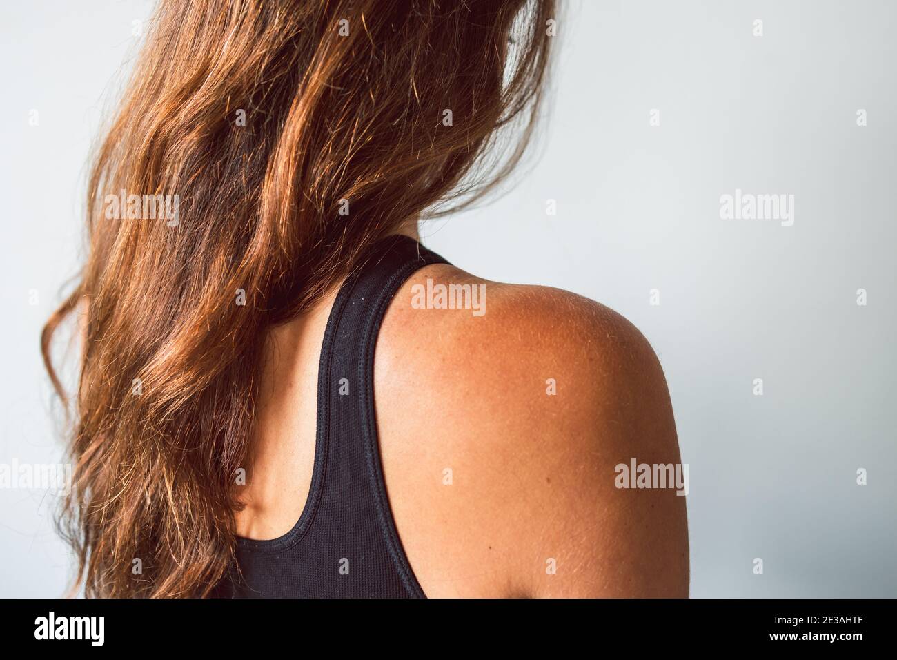 sun exposure and sunscreen use concept, girl revealing intense tan ...