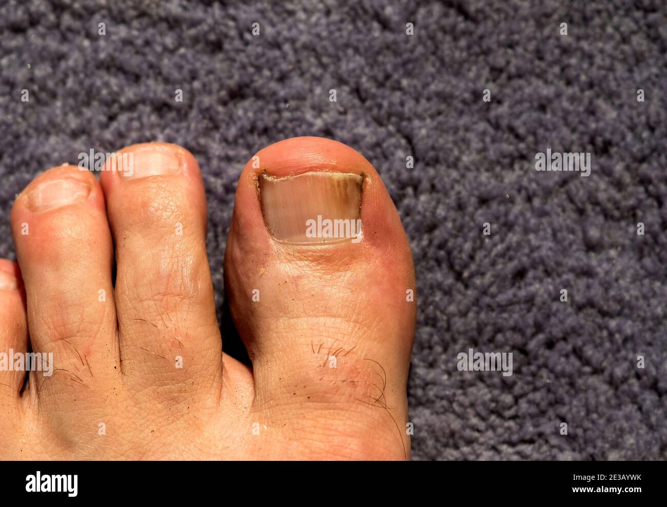 Big toe on a mans left foot Stock Photo - Alamy