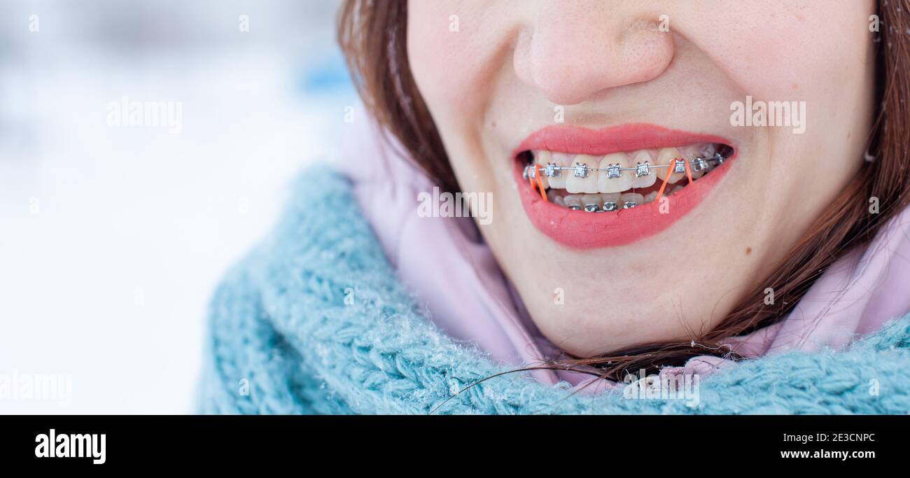 The girl has braces on her teeth. A girl in the winter on the street ...