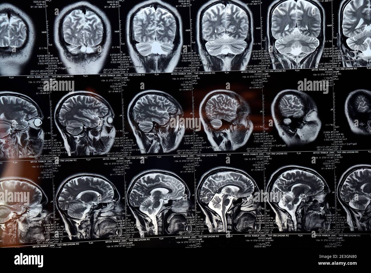MRI Brain Scan of Head and Skull Stock Photo - Alamy
