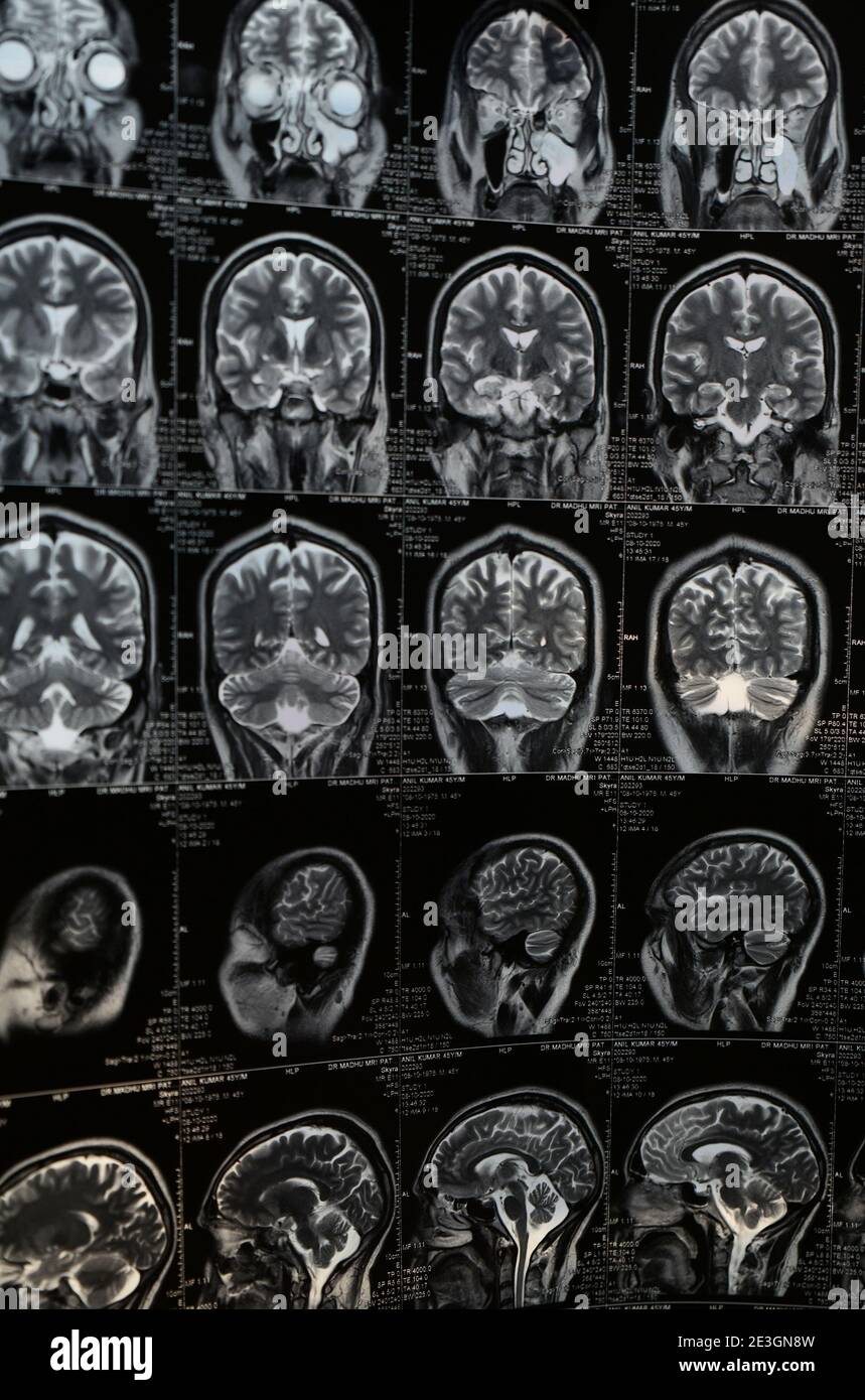 Human brain scan mri not health hi-res stock photography and images - Alamy