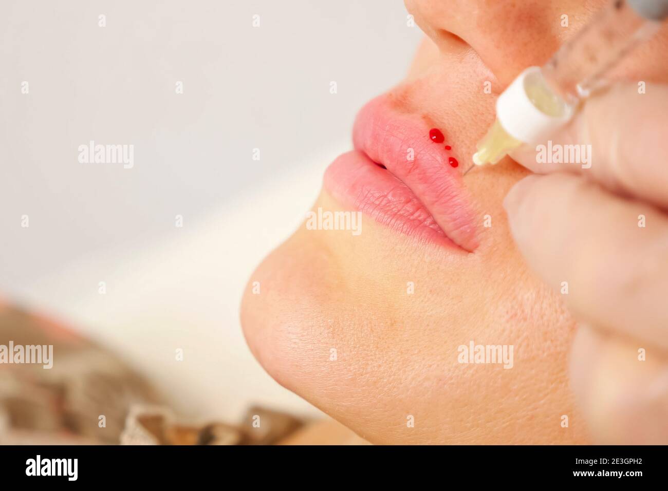 Professional cosmetic surgeon injects lady lips with special ...