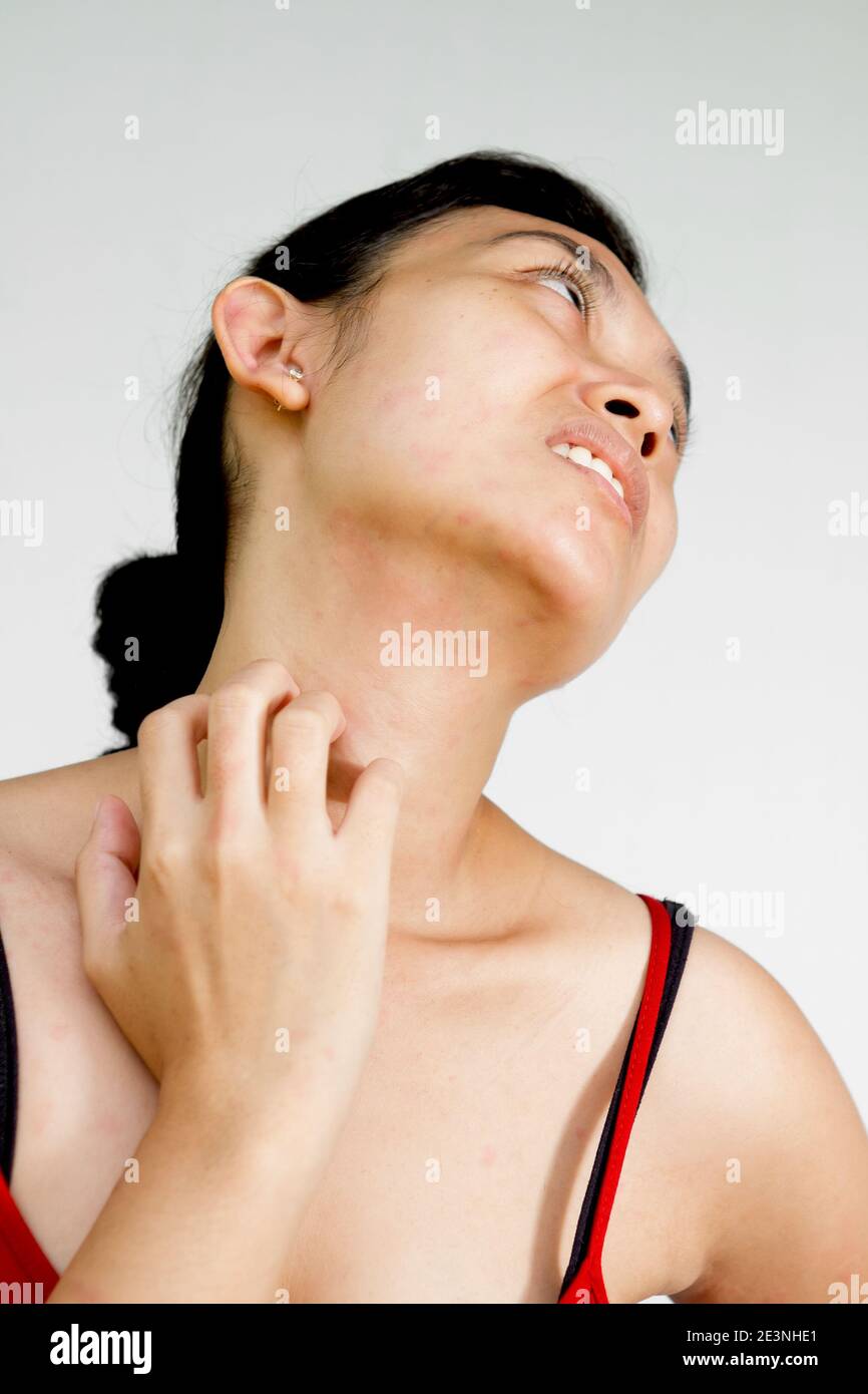 Dermatitis eczema face rash hi-res stock photography and images - Alamy