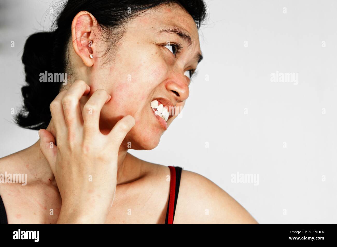 Asian skin rash hi-res stock photography and images - Alamy