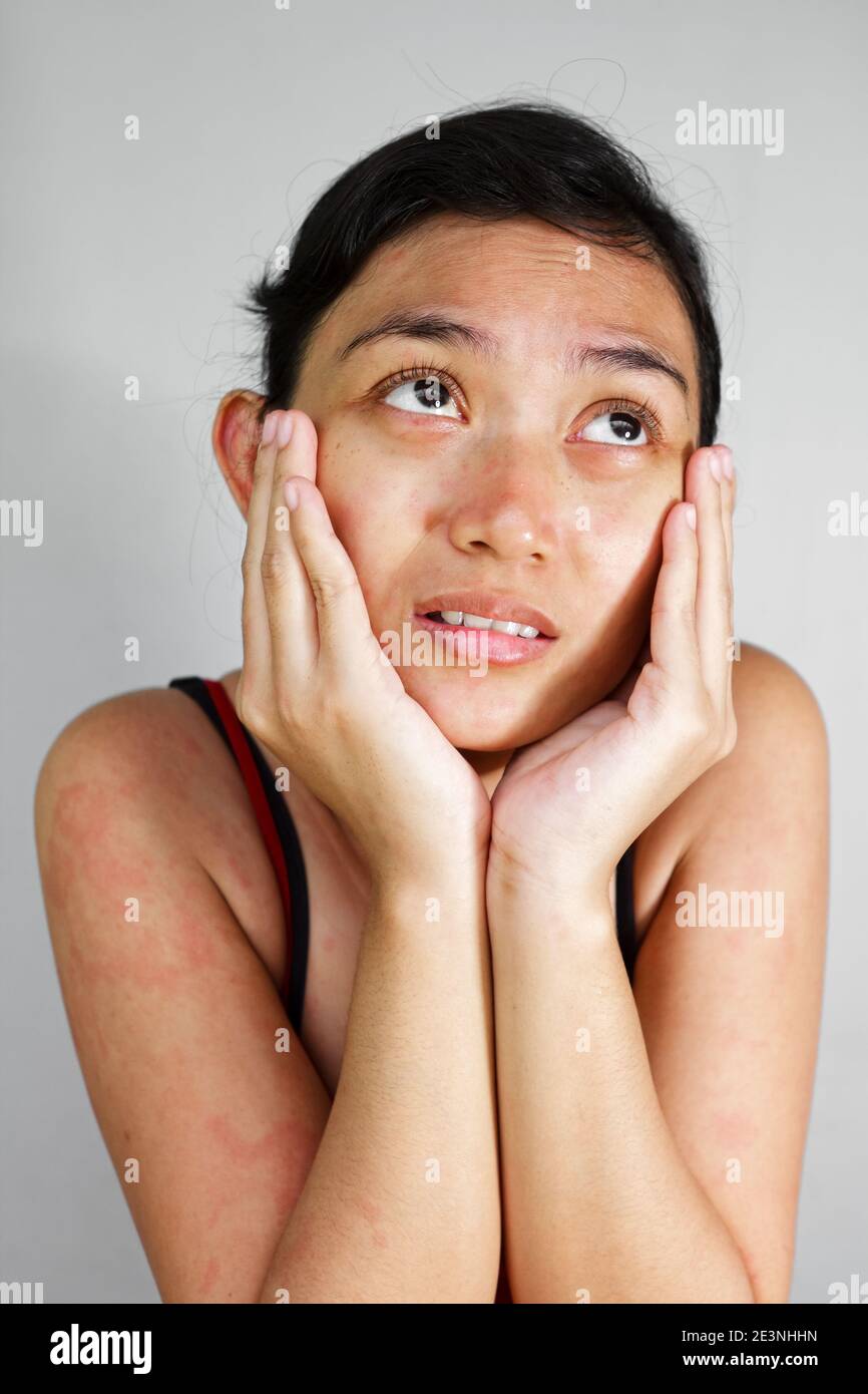 Asian skin rash hi-res stock photography and images - Alamy
