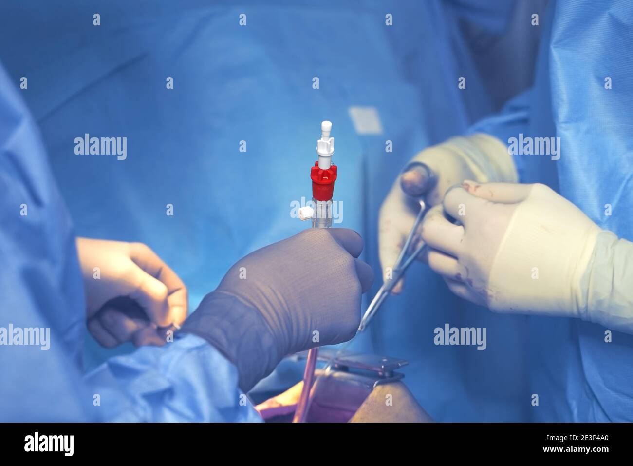 Cannulation in surgical practice. Progress of the operation Stock Photo ...