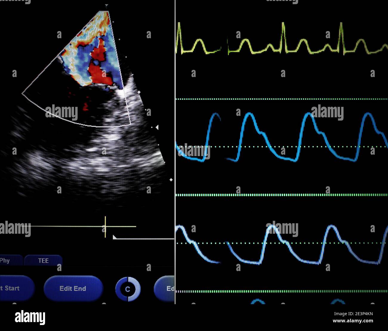 Echocardiographic parameters synchronized with ECG. Screen of a modern ...