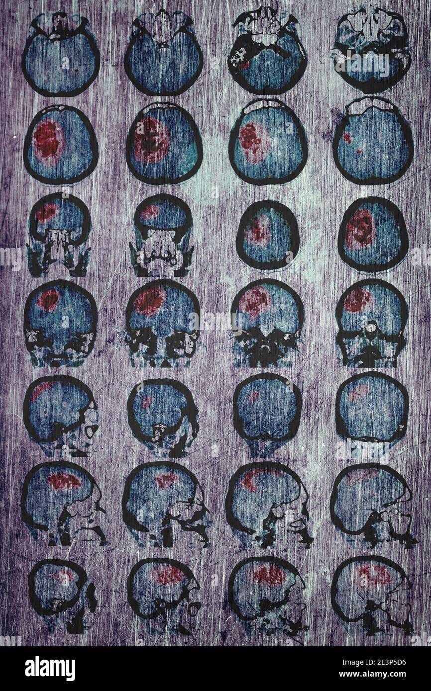 Scanning of human brain on the textured steel surface Stock Photo - Alamy