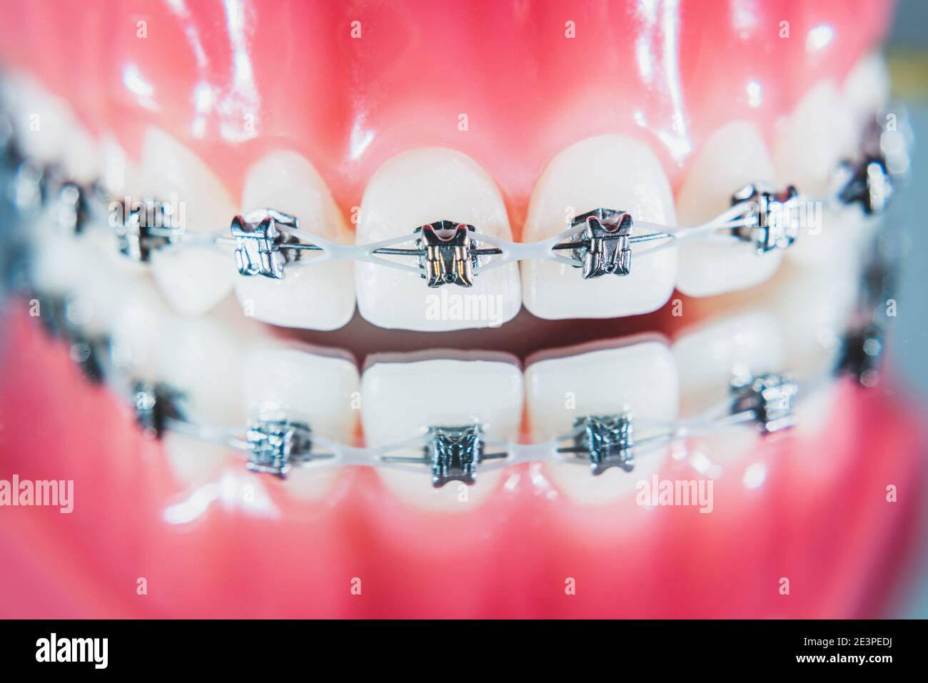 Teeth braces in the artificial jaw. Macro photography Stock Photo - Alamy