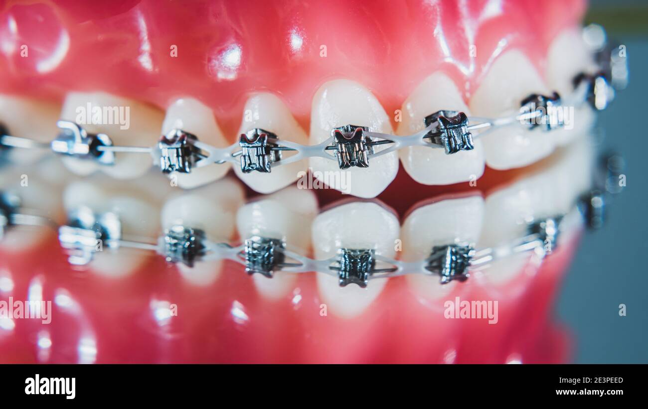 macro photography shows how the braces are arranged Stock Photo - Alamy