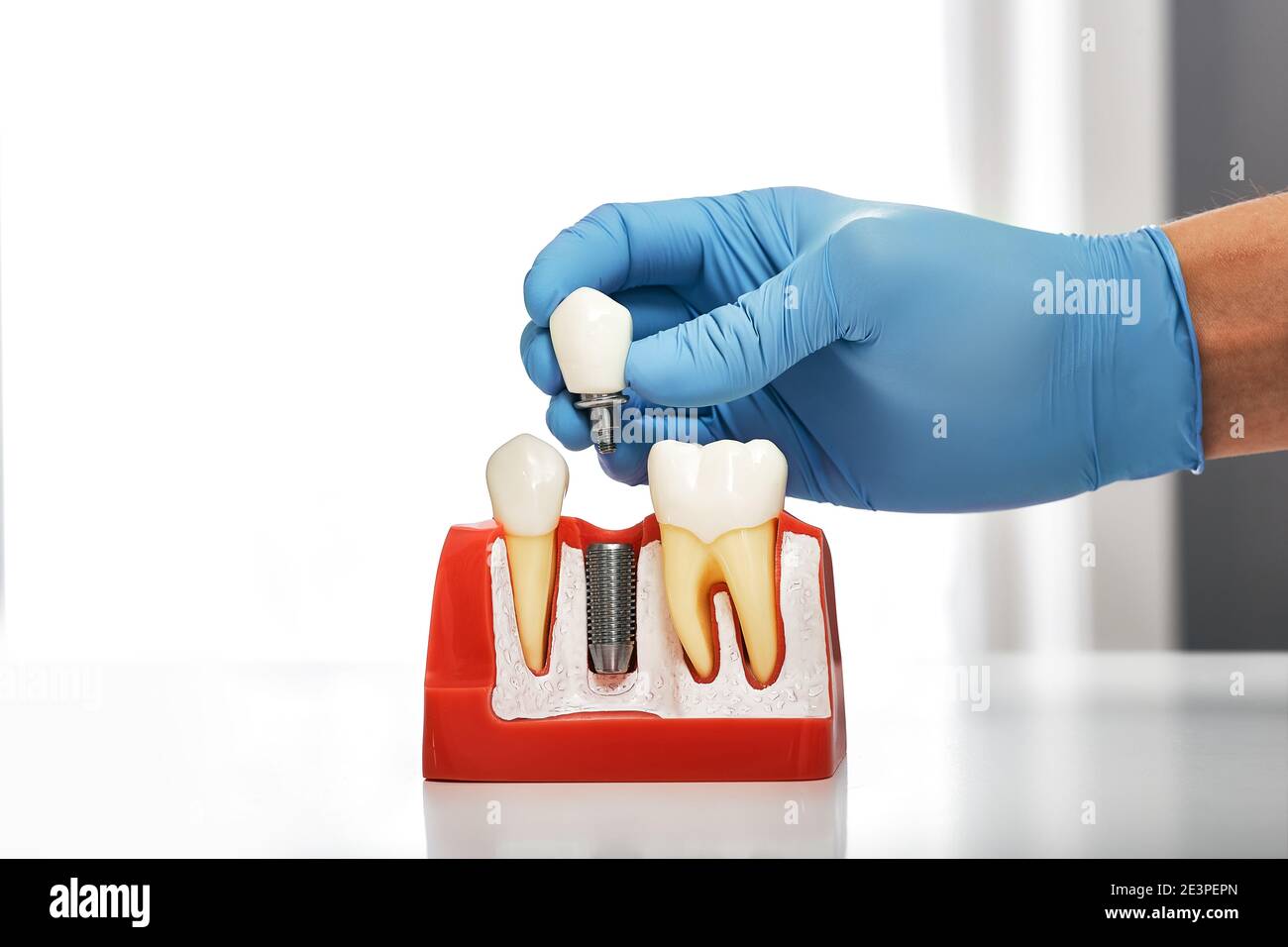 Dentist showing the installation of a dental implant on the anatomical ...