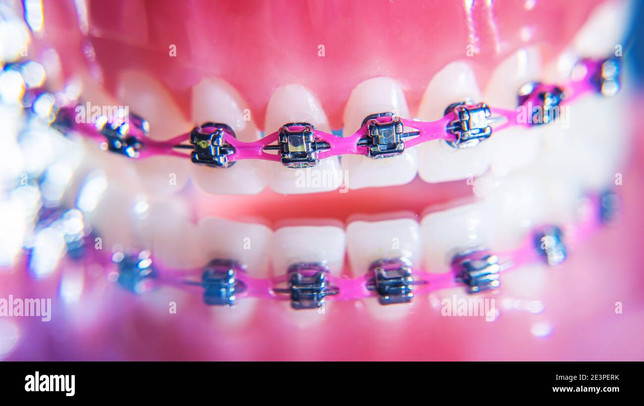 Dentures with braces hi-res stock photography and images - Alamy
