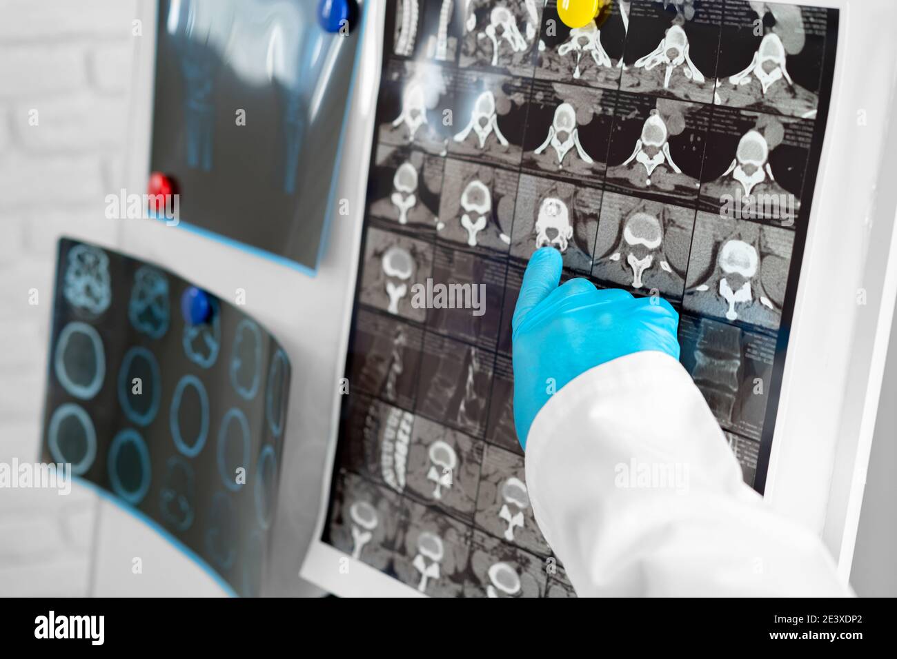 Doctor examining mri scan head hi-res stock photography and images - Alamy