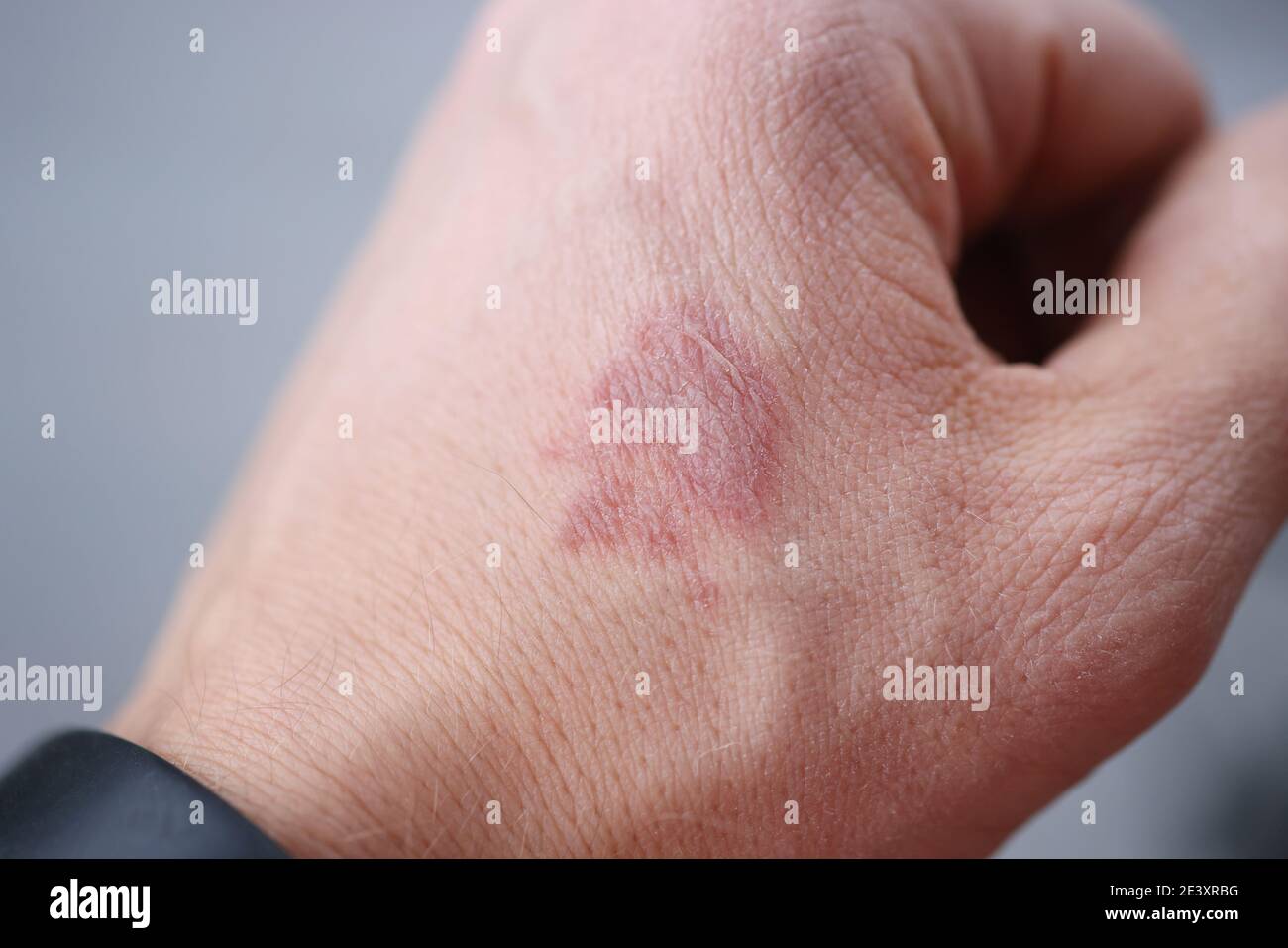 Chemical burn to the hand hi-res stock photography and images - Alamy