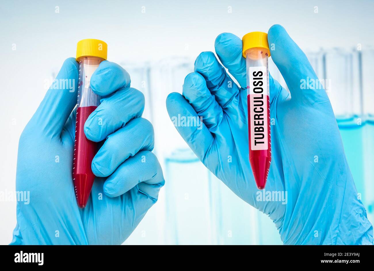 Scientists hand holding a test-tube with blood sample for TUBERCULOSIS ...