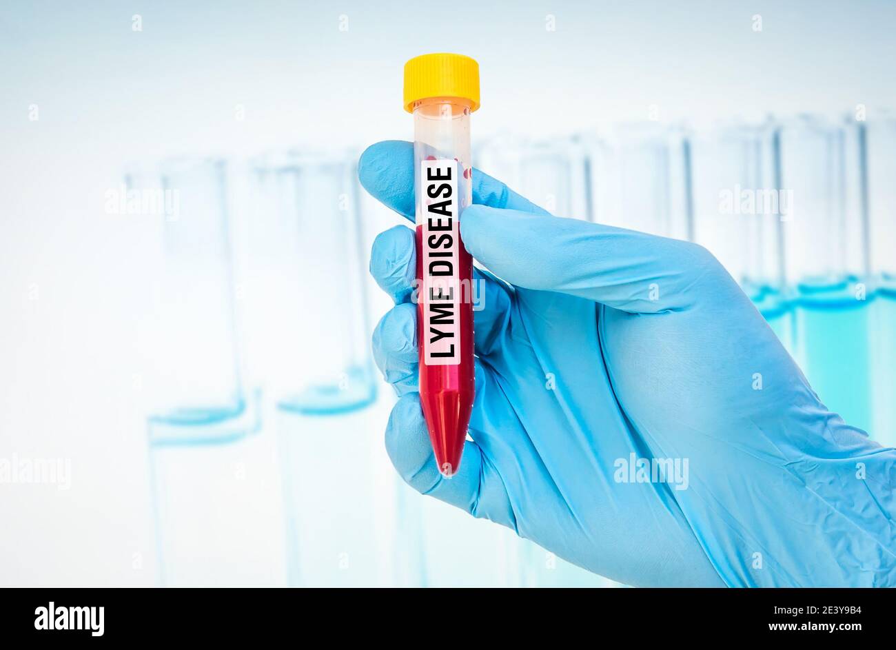 Scientists hand holding a test-tube with blood sample for LYME DISEASE ...
