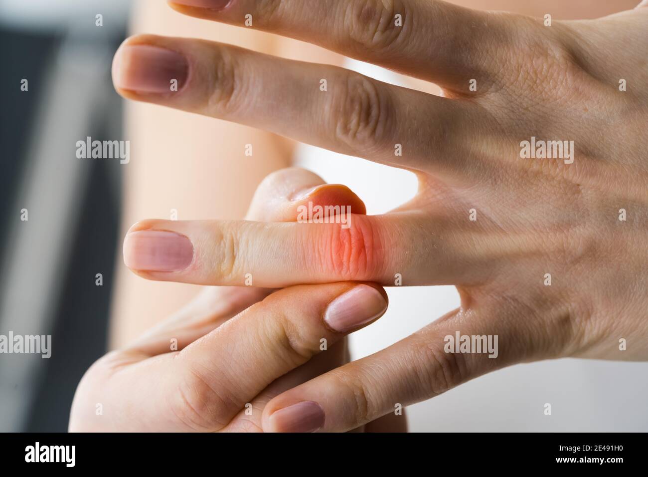 Inflammation finger hi-res stock photography and images - Alamy