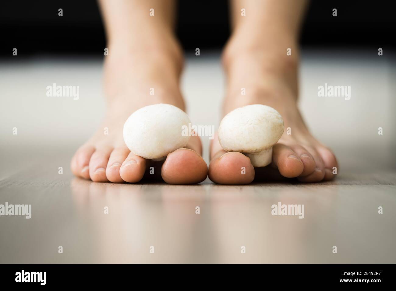 Fungus Mushroom Between Toenail. Smelly Feet And Fungi Stock Photo - Alamy