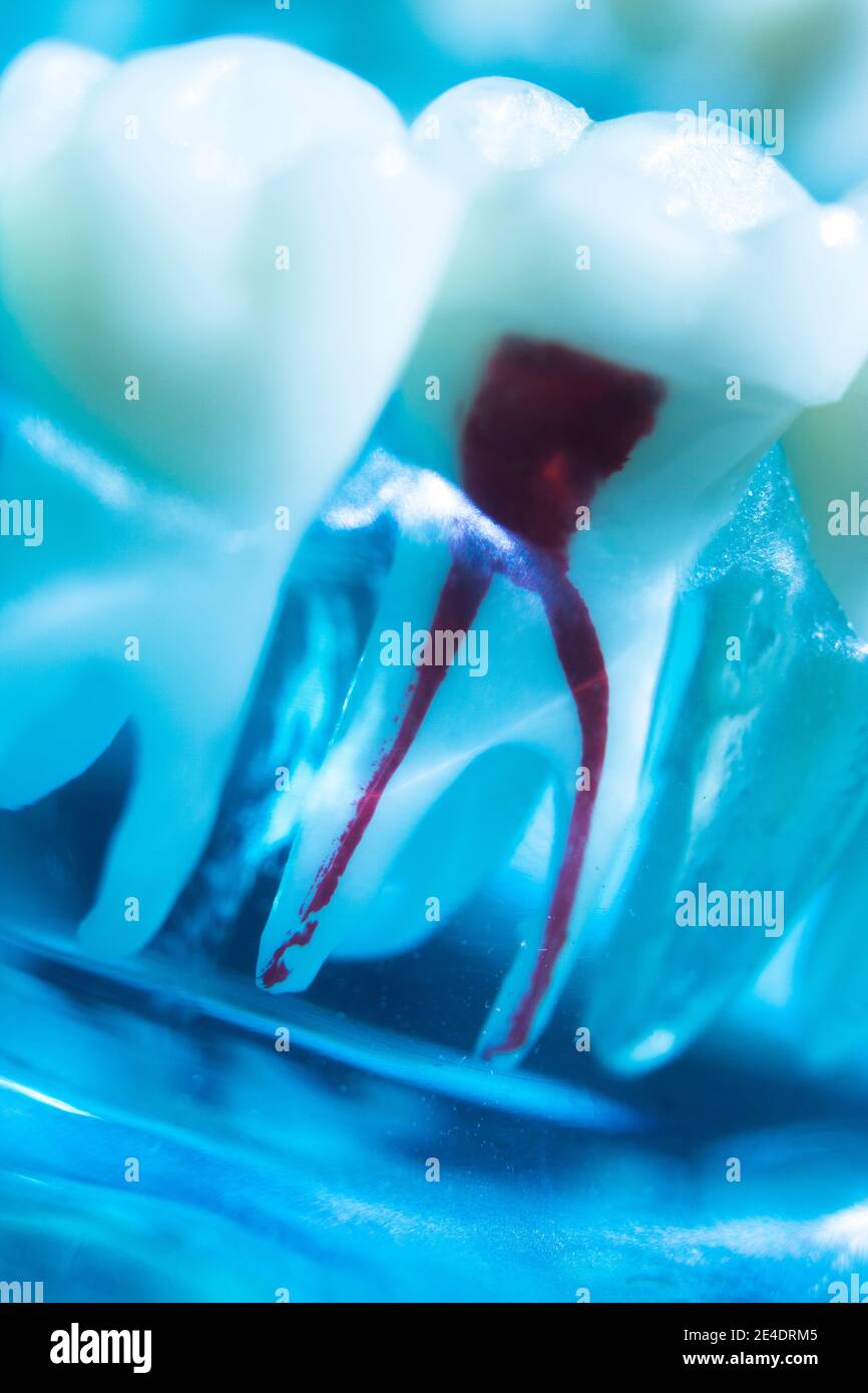 tooth decay going to root canal in teeth teaching medical model Stock ...