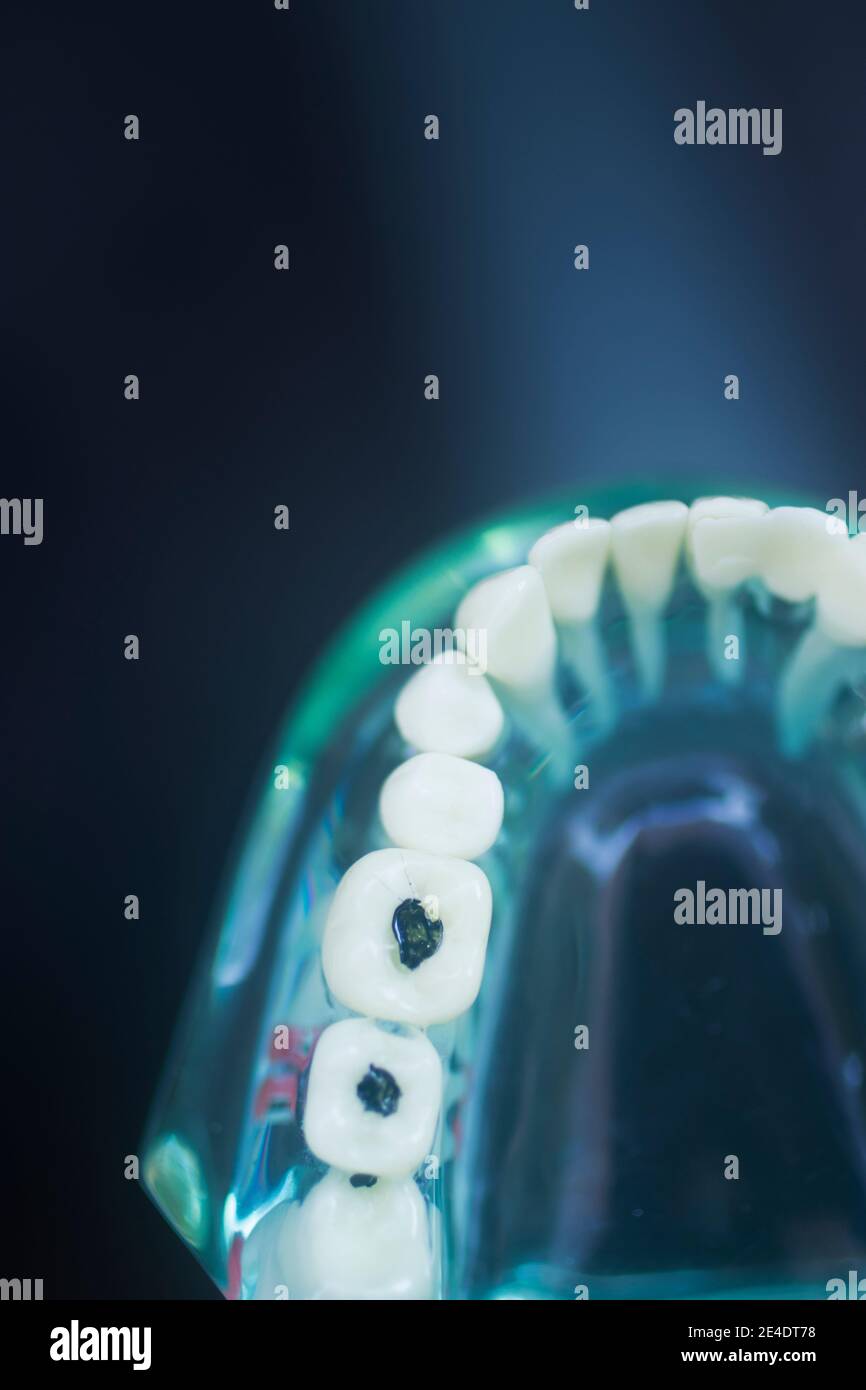 Teeth decay dentistry model showing caries in tooth Stock Photo - Alamy