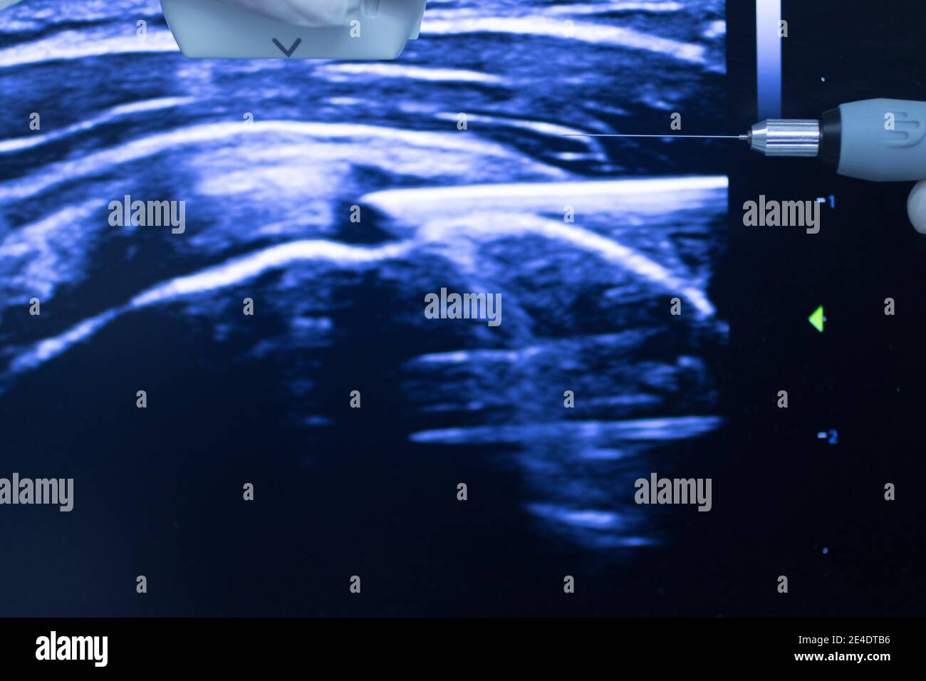 EPI Intratissue Percutaneous Electrolysis dry needling ultrasound ...