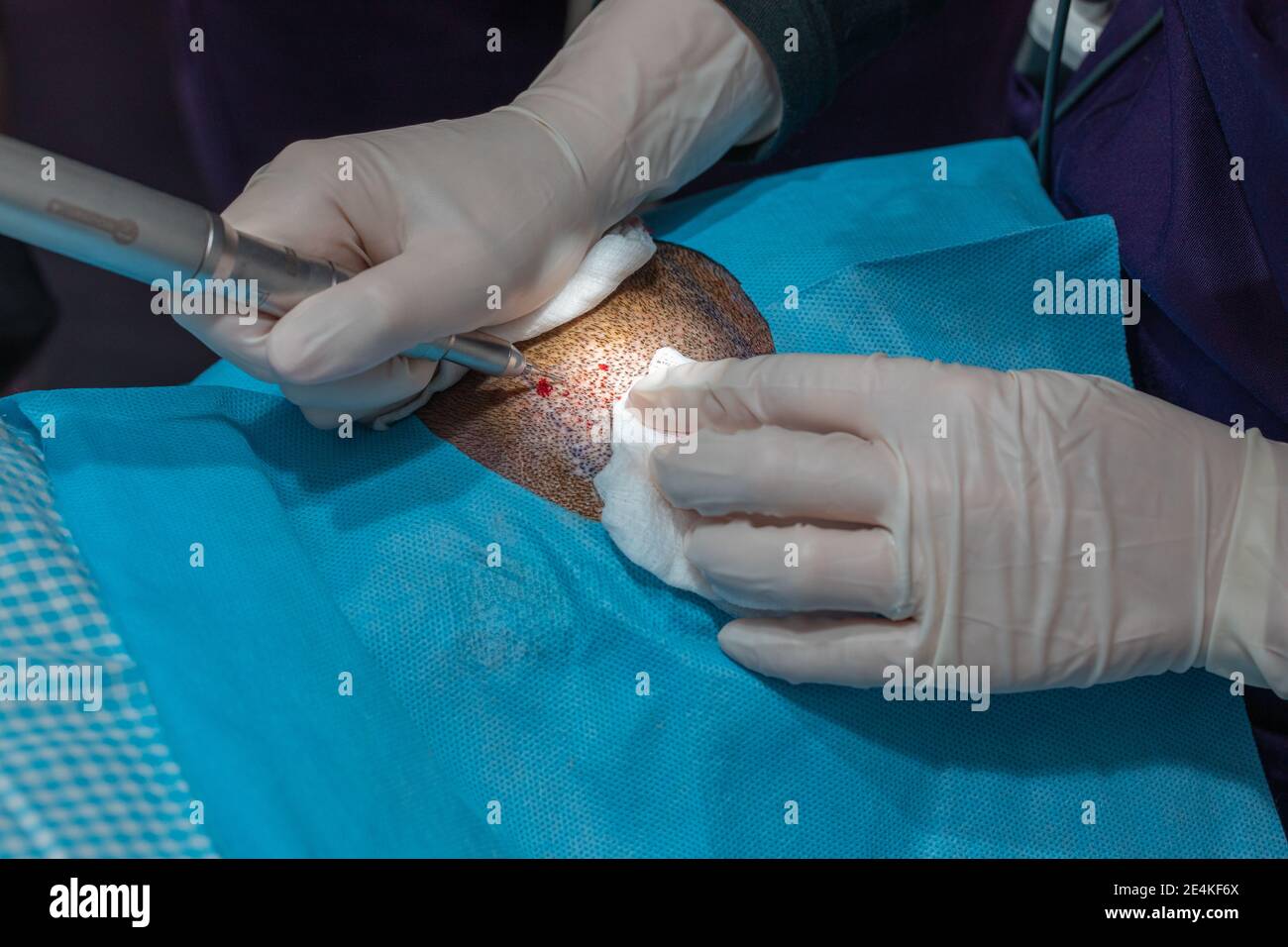 Hair Implant Process, Collecting Hair Plasma for Implanting Process ...