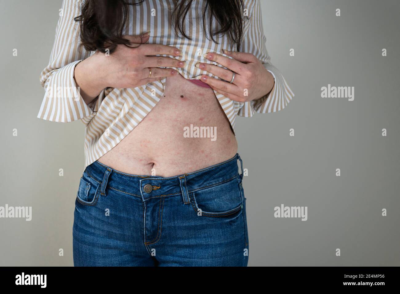 Women with symptoms of itchy urticaria or allergic reaction on the skin ...