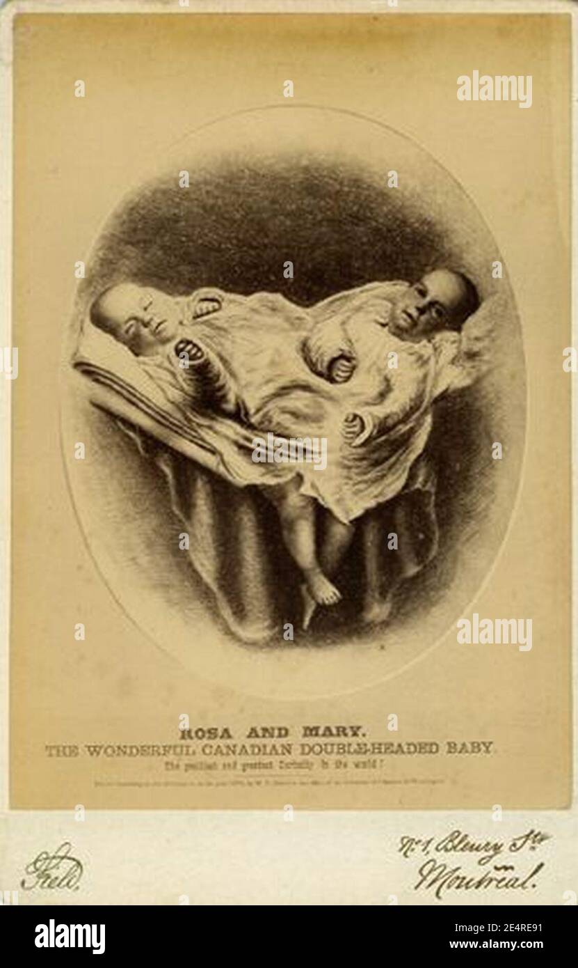 Mary and Rosa Drouin - The Wonderful Canadian Double-Headed Baby (John ...
