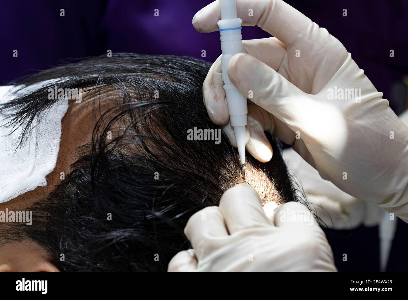 Hair Implant Process, Collecting Hair Plasma for Implanting Process ...