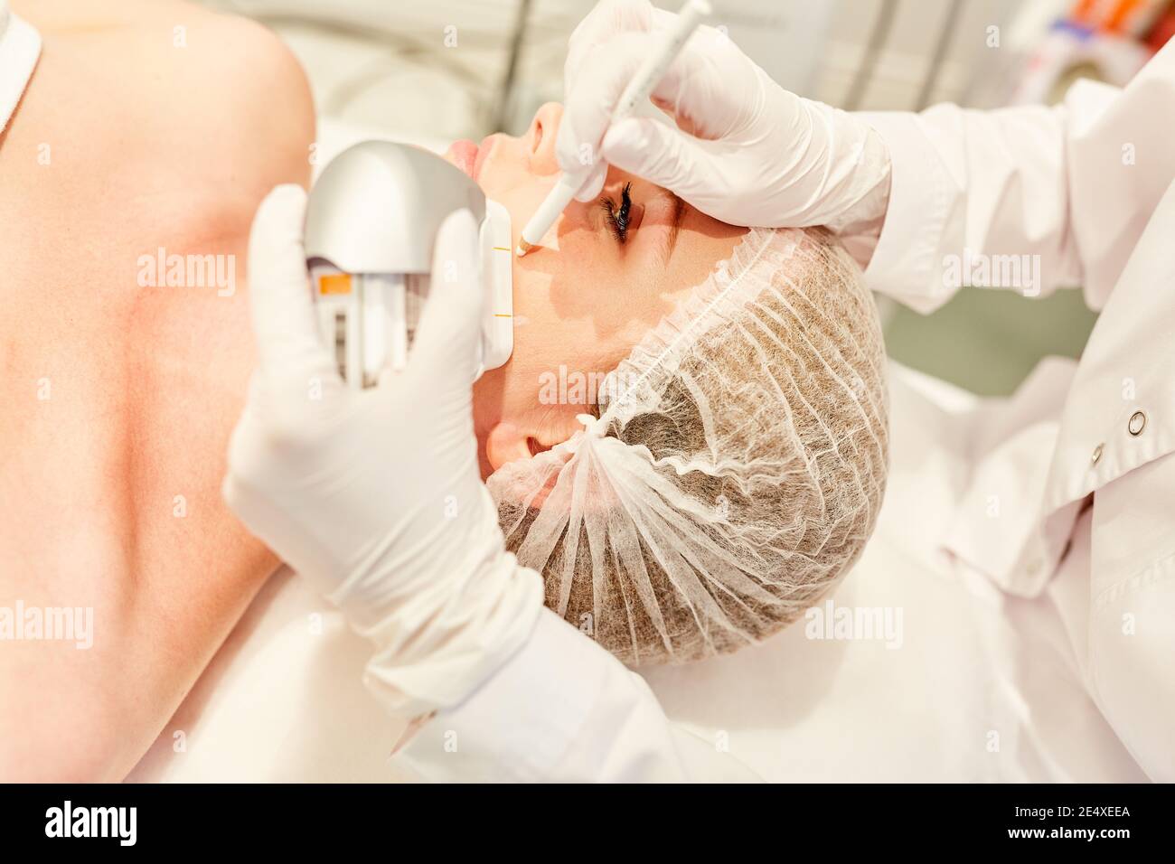 Preparation for skin tightening by ultrasound on a woman's face at the ...