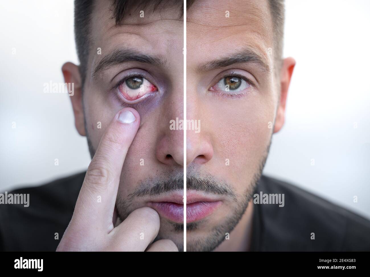 Heroin Addiction Before And After Pictures Heroin Addiction Before And After Pictures