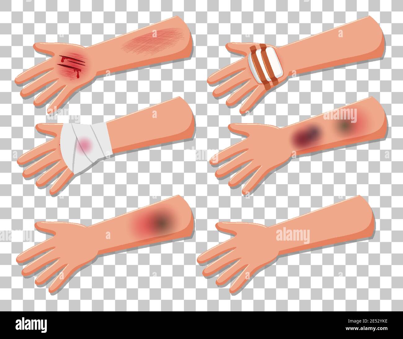 Set of injury arms on transparent background illustration Stock Vector ...
