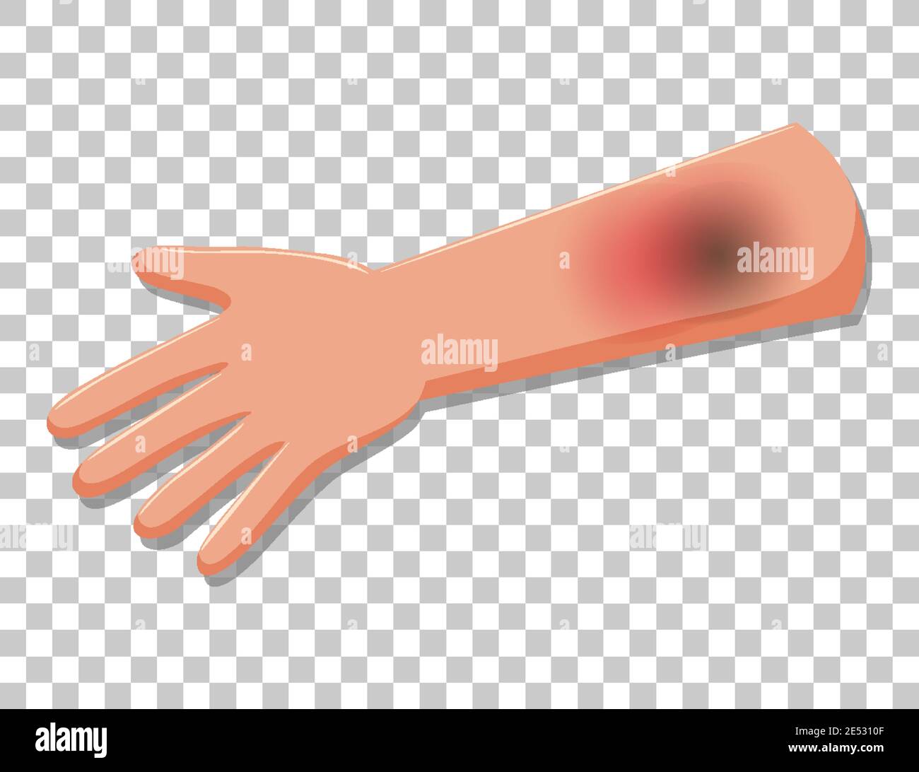 Bruised skin on an arm isolated on transparent background illustration ...