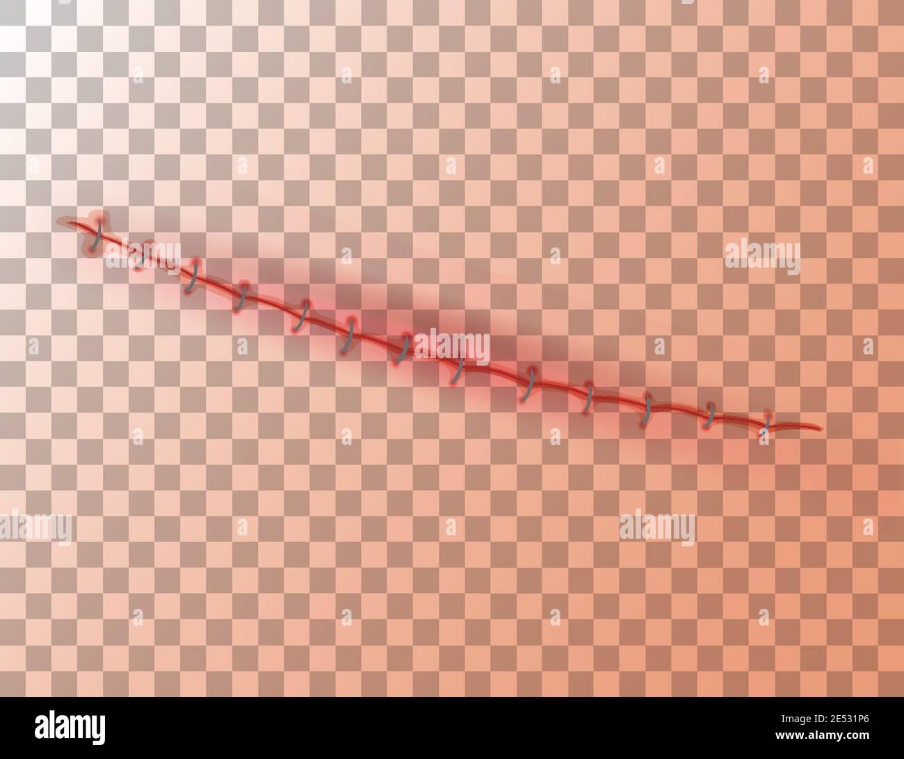 Wound suturing on transparent background illustration Stock Vector ...
