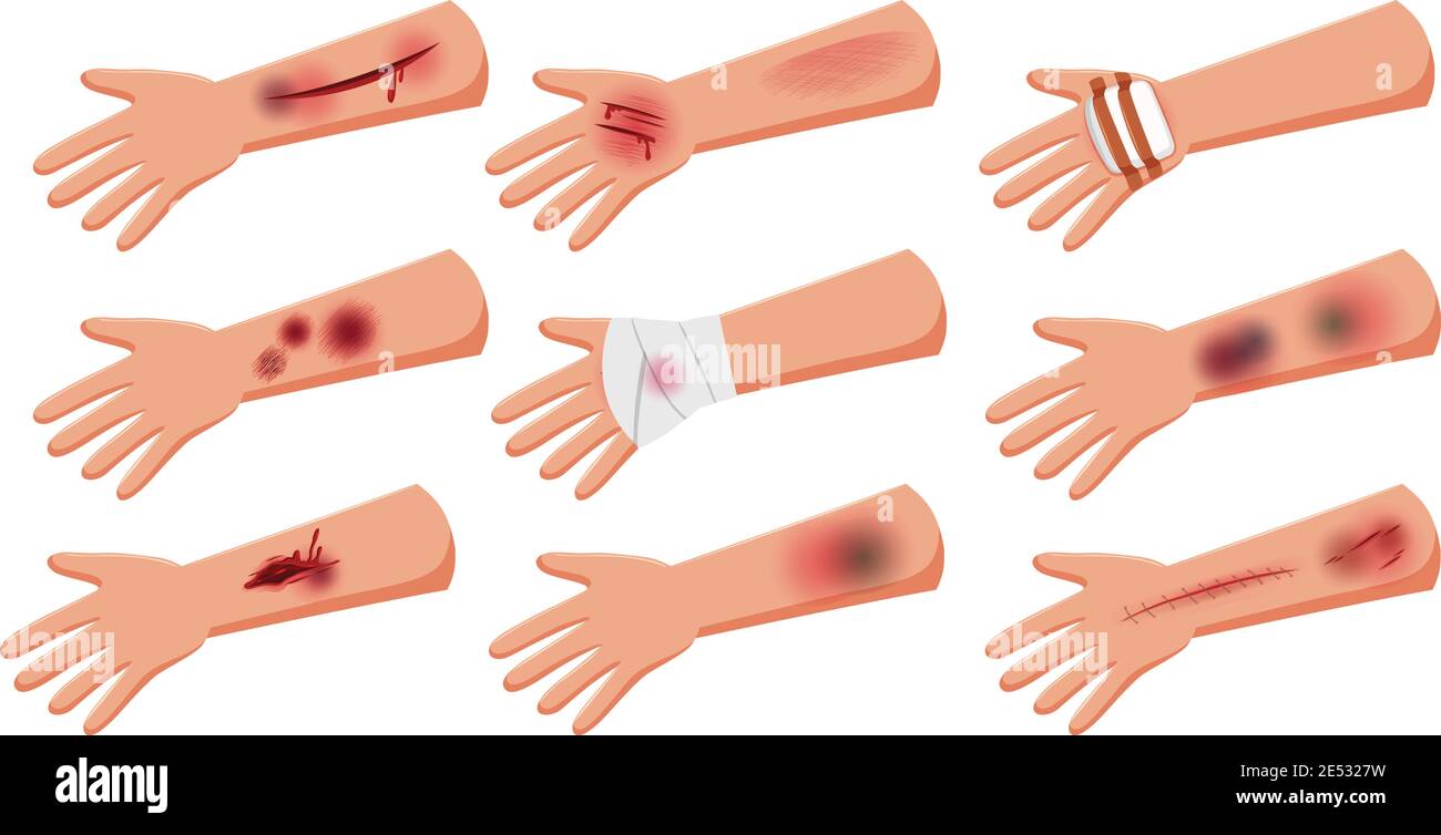 Group of lesion on arm skin injury accident cartoon style illustration ...