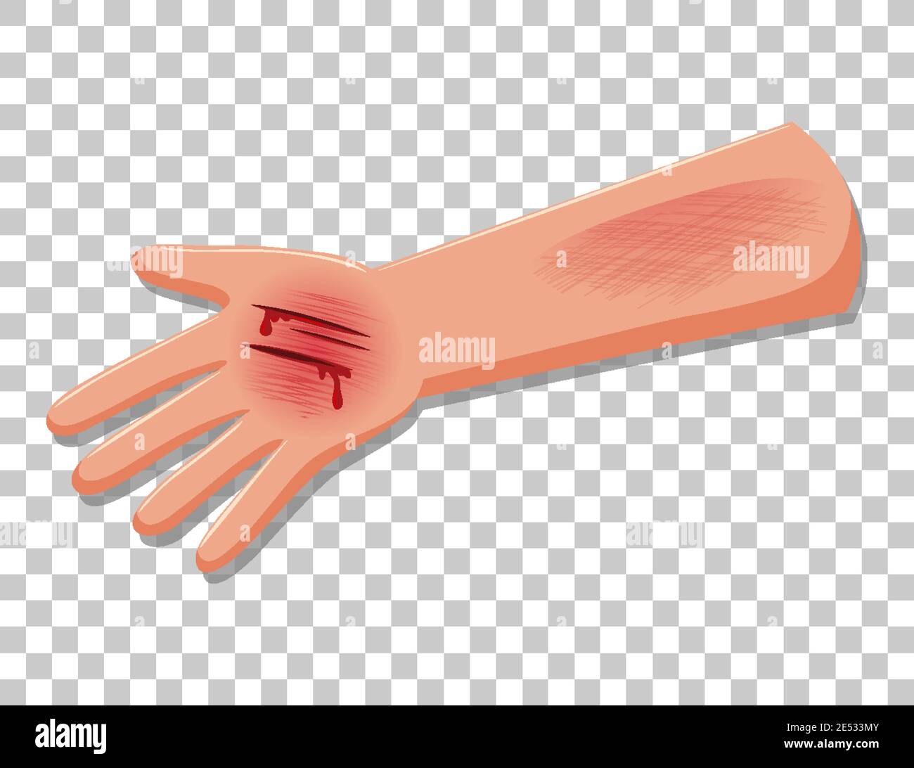 Skin abrasion hi-res stock photography and images - Alamy