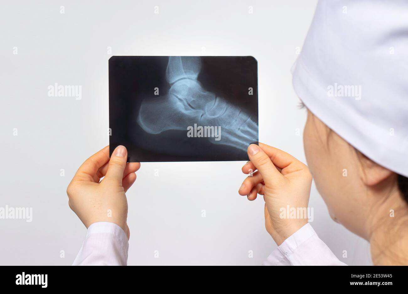 Broken leg xray hi-res stock photography and images - Alamy
