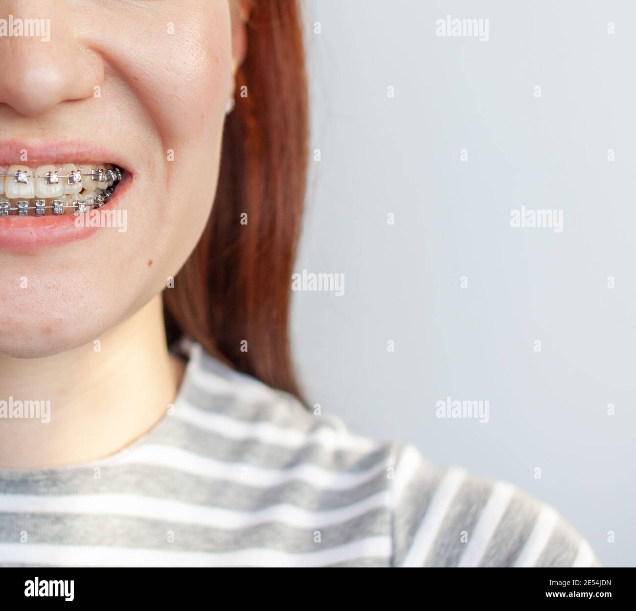 Braces in the smiling mouth of a girl. Smooth teeth from braces Stock ...