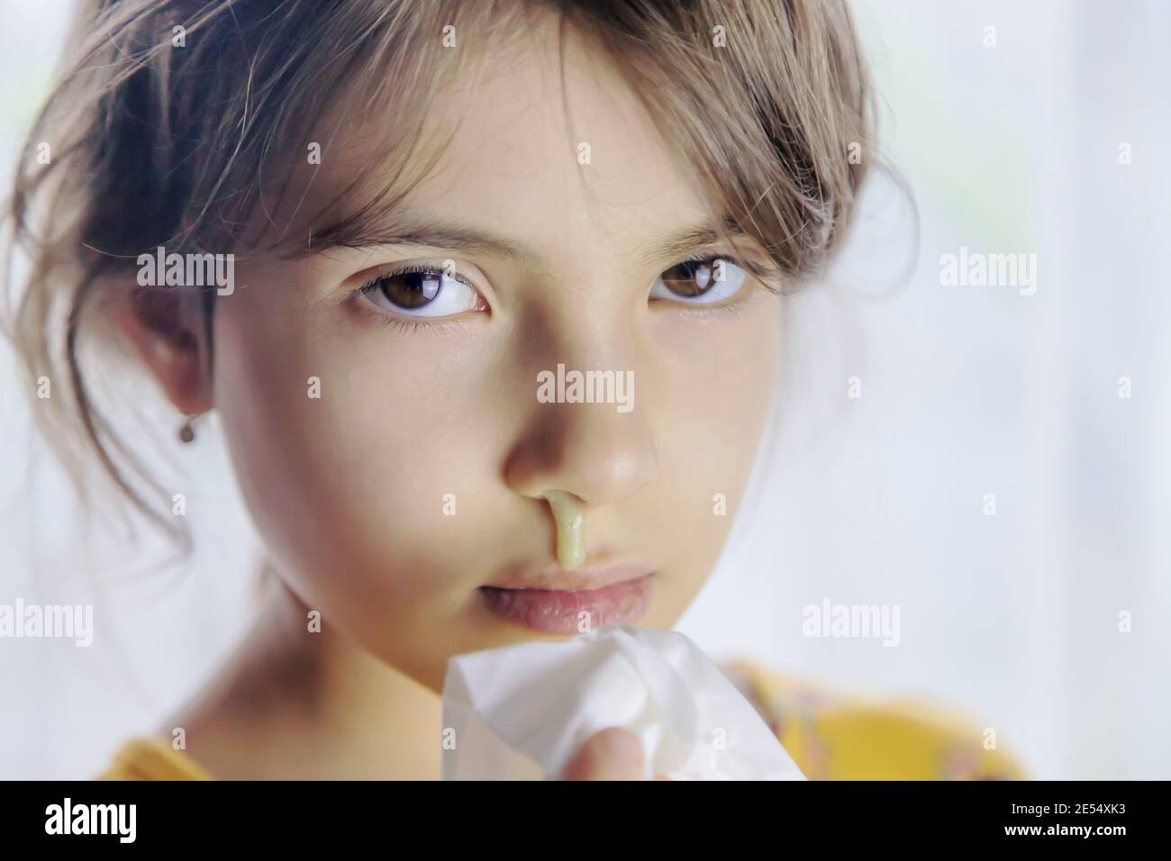 Snot in a child face close-up. Cold. Selective focus. People Stock ...