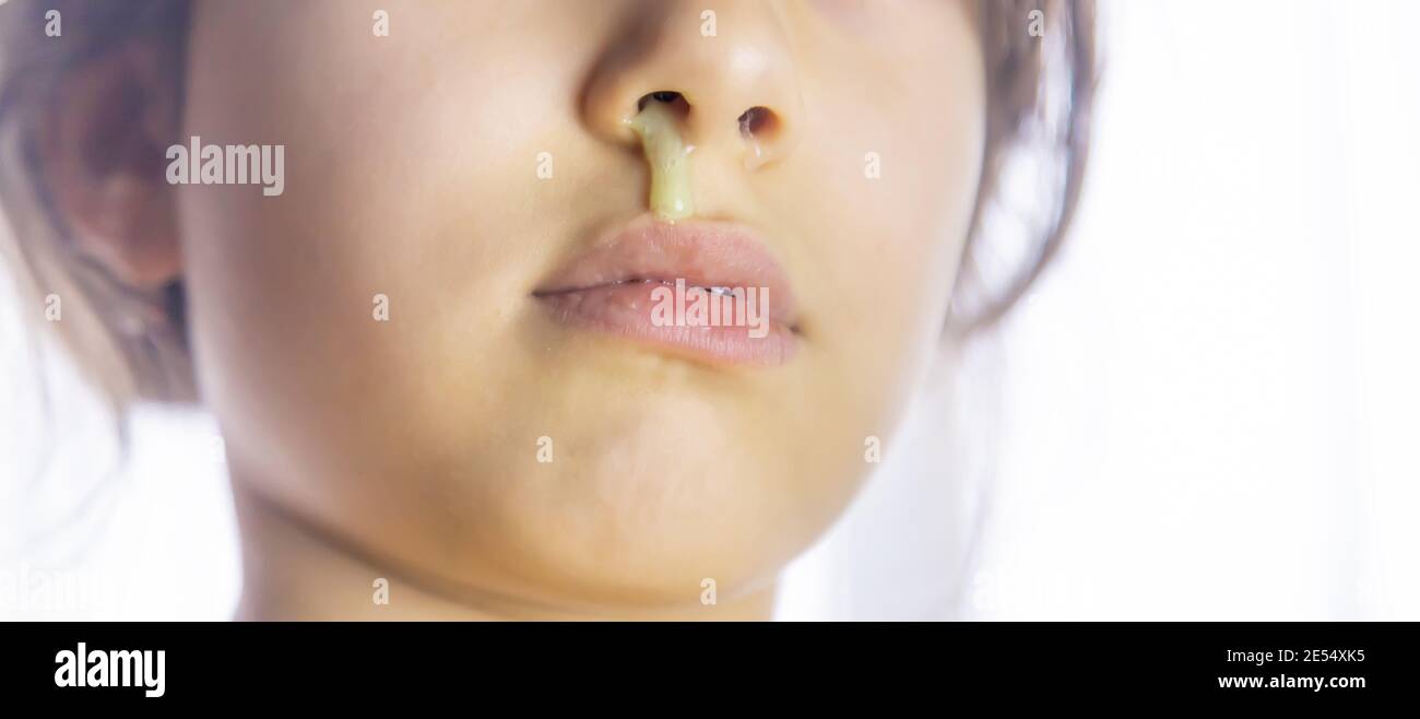 Snot in a child face close-up. Cold. Selective focus. People Stock ...
