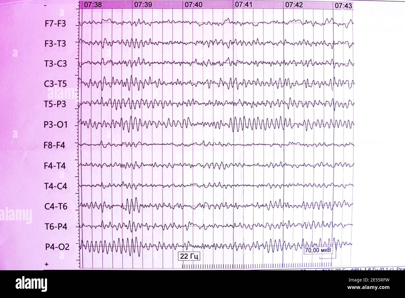 The results of the electroencephalogram on paper, diagnostics of ...