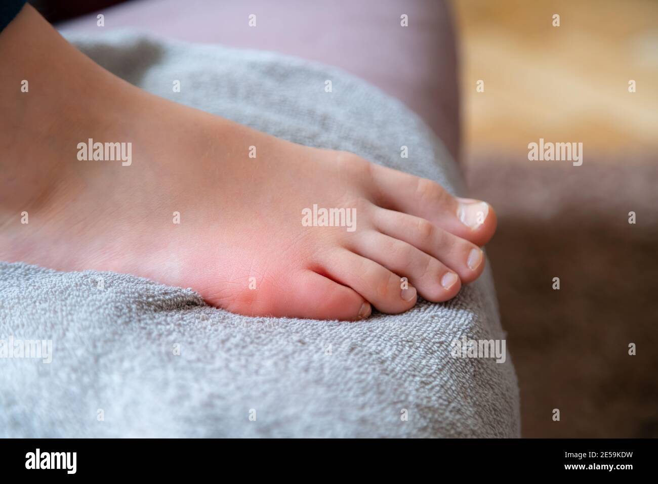 Close up of swollen leg finger. Possibly broken leg. Painful accident ...