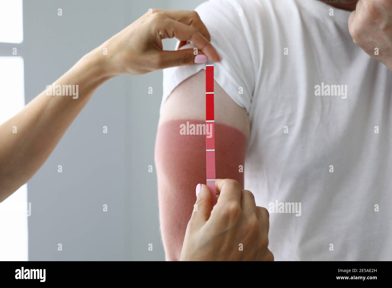 Skin test ruler hi-res stock photography and images - Alamy