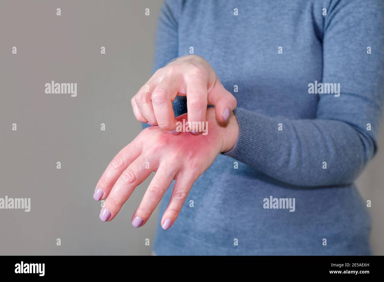 The girl in the gray jumper scratches her hand. Scabies. Inflammation ...