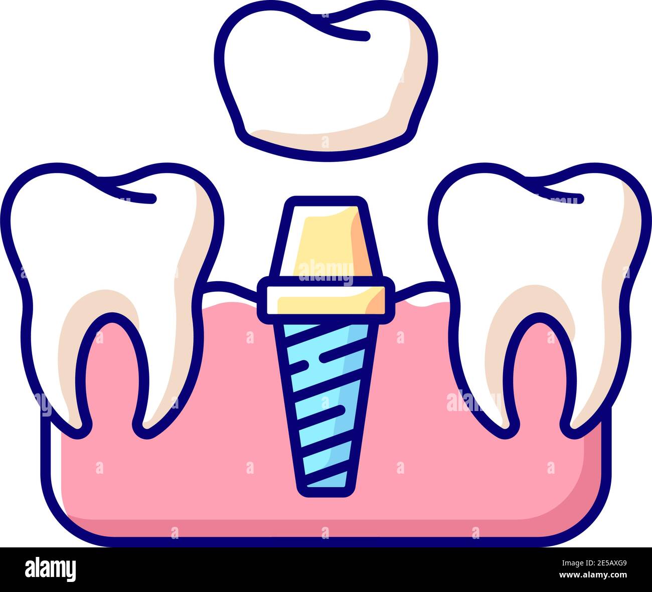 Dental implants procedure RGB color icon Stock Vector Image & Art - Alamy