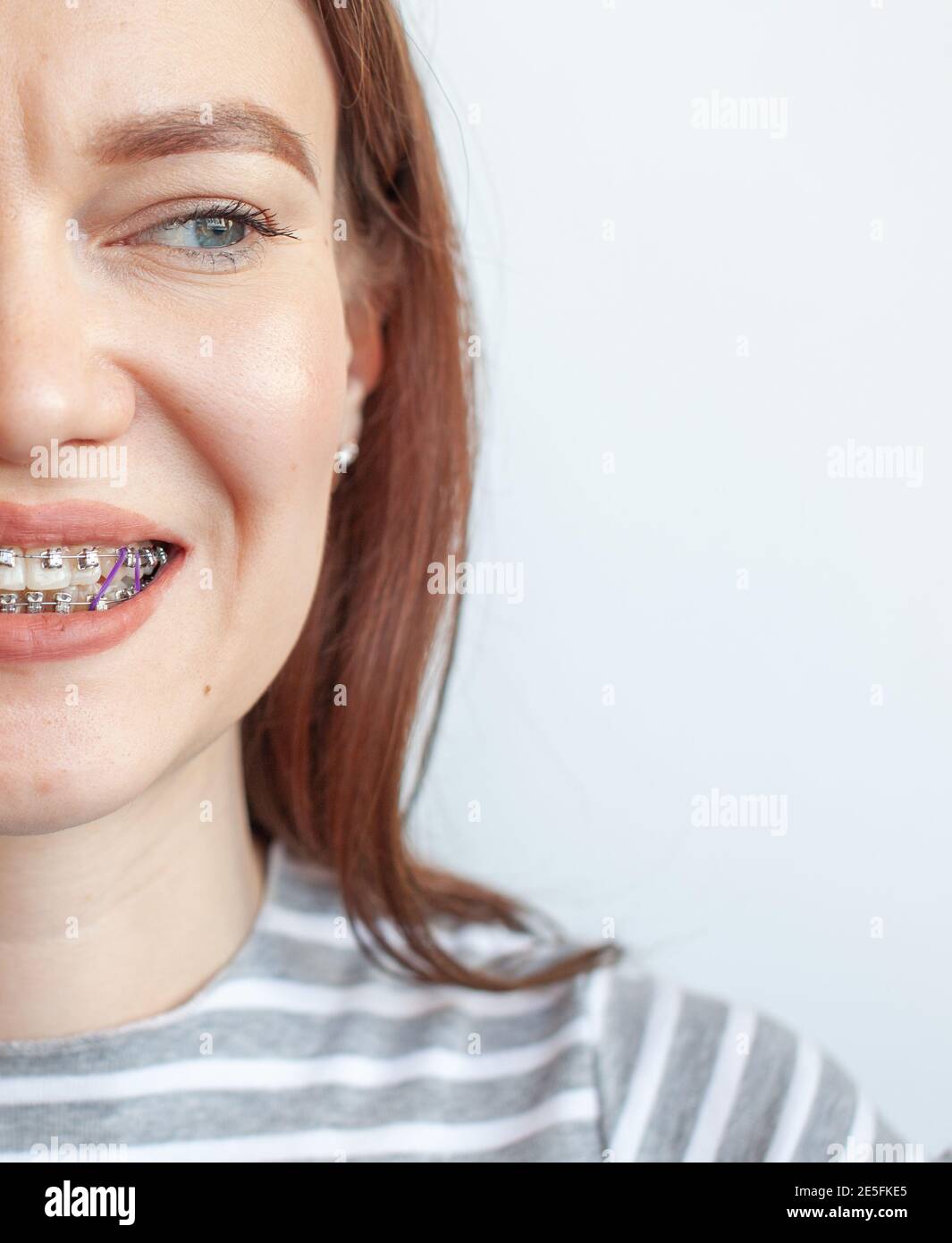 Braces in the smiling mouth of a girl. Smooth teeth from braces Stock ...